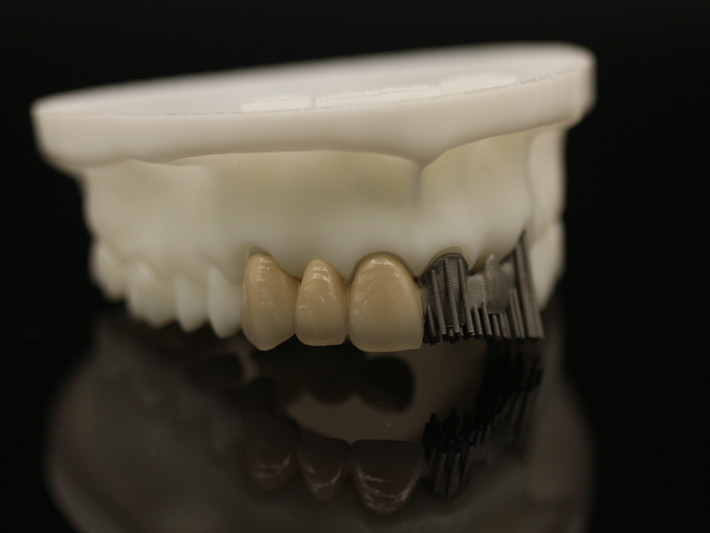 Porcelain-Fused-to-Metal (PFM) Crowns | Dental Lab Manufacturers ...
